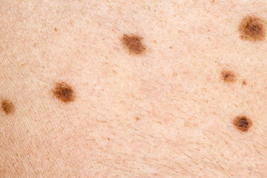 Melanoma: The small percentage with a big impact - For Your Health